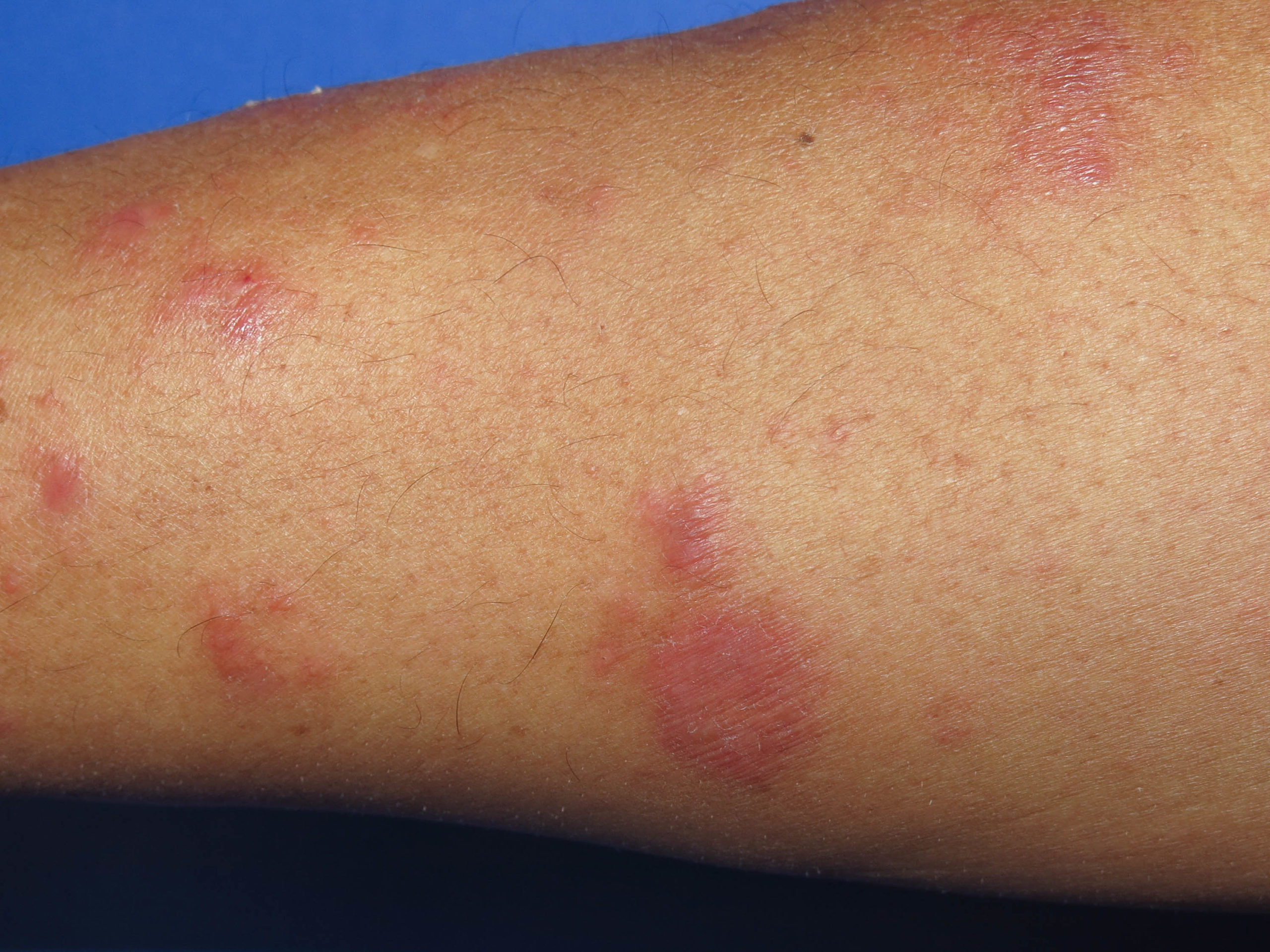 Sweet Syndrome Symptoms