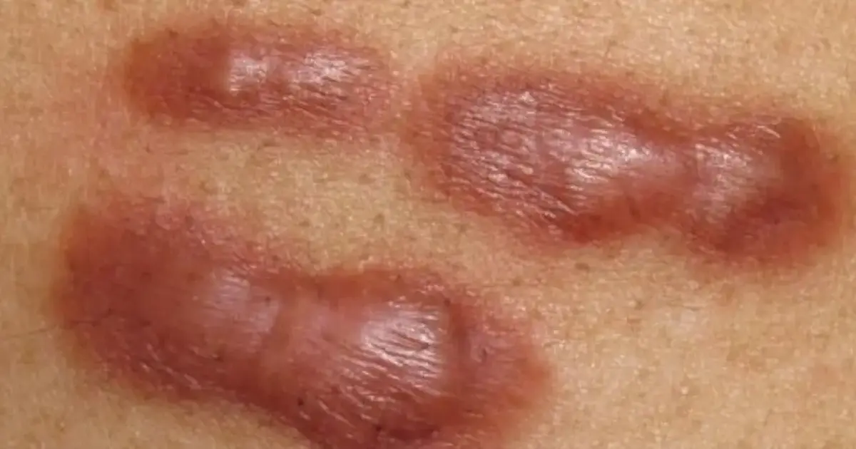 Dealing with keloid scars | British Skin Foundation